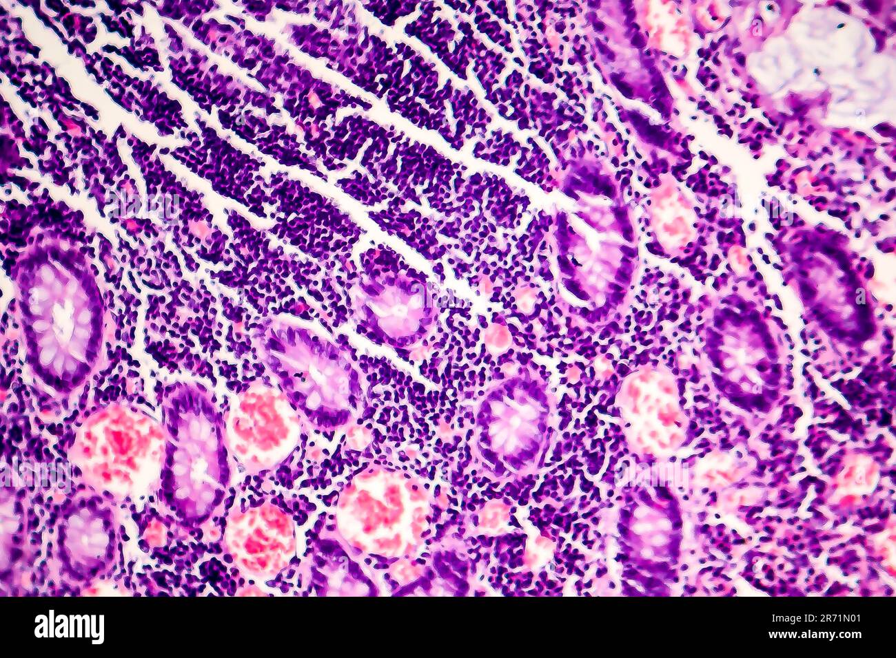 Poorly differentiated intestinal adenocarcinoma, light micrograph ...