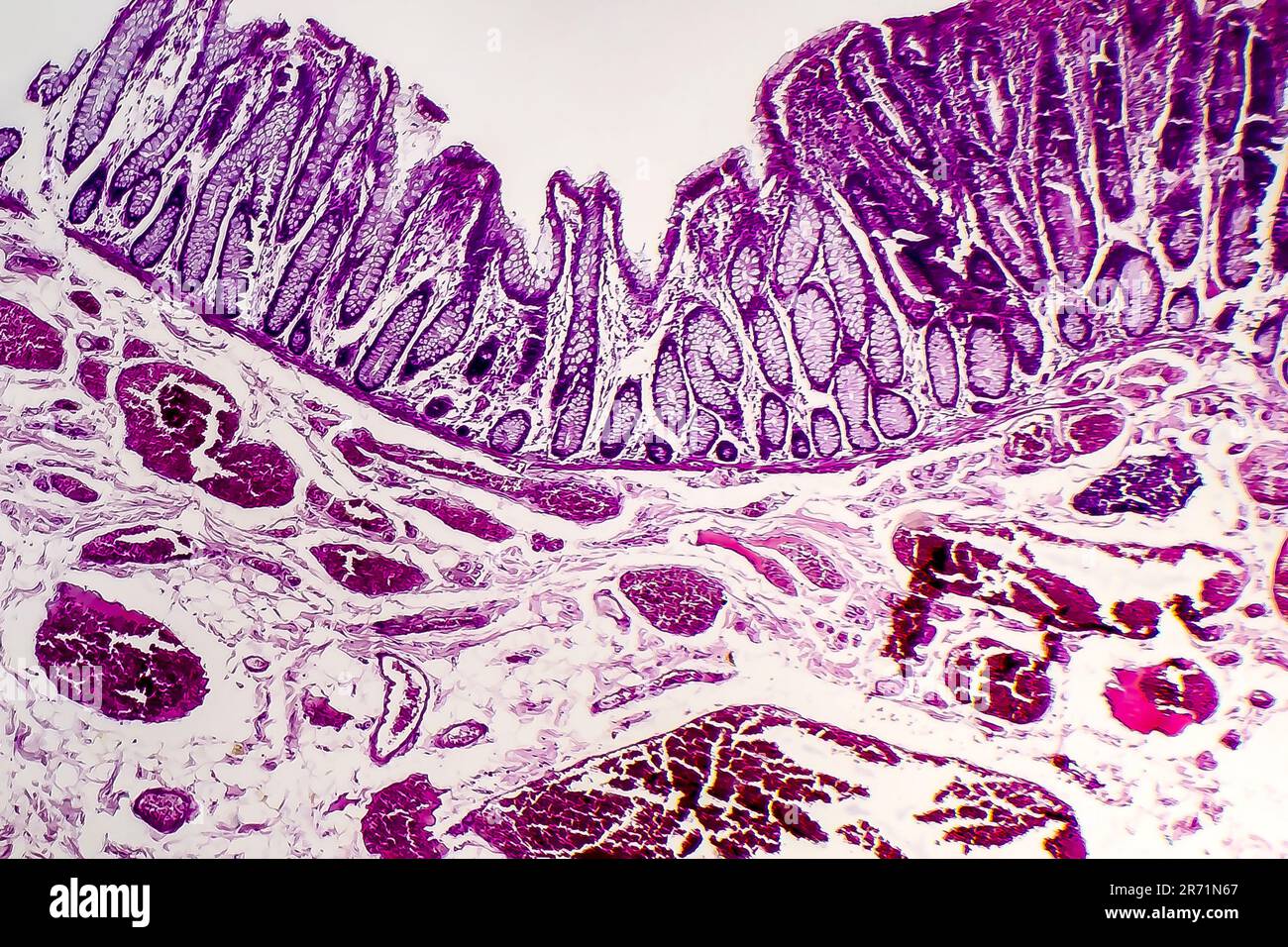 Villous colon adenocarcinoma, light micrograph, photo under microscope ...