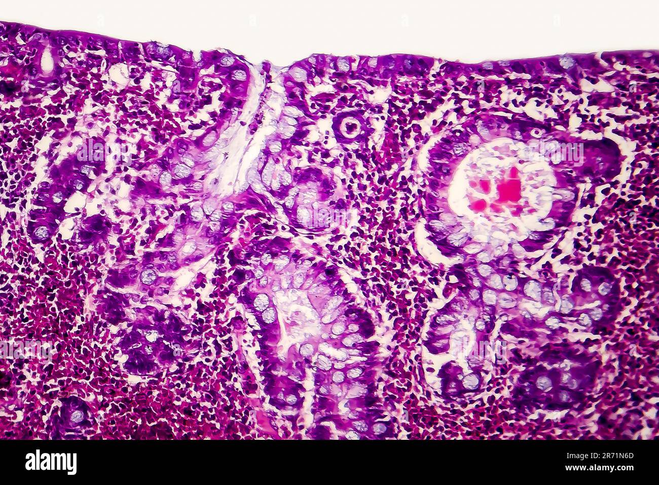 Villous colon adenocarcinoma, light micrograph, photo under microscope ...