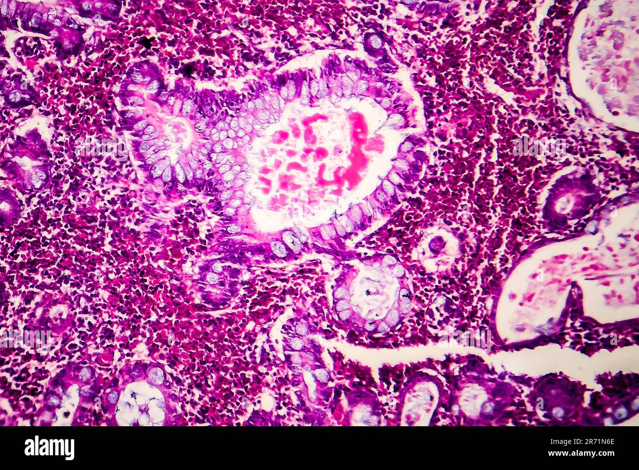 Villous colon adenocarcinoma, light micrograph, photo under microscope ...
