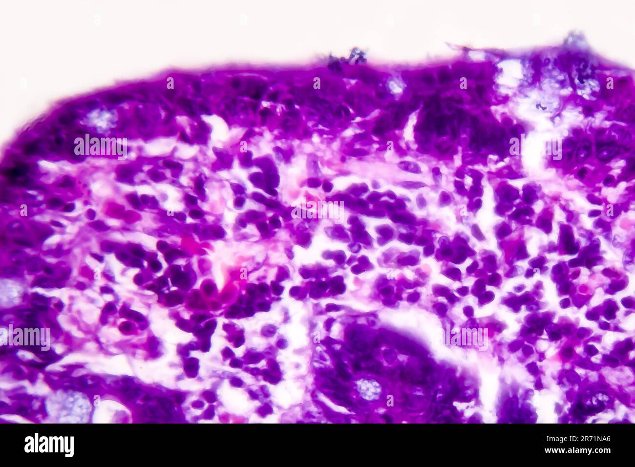 Villous colon adenocarcinoma, light micrograph, photo under microscope ...