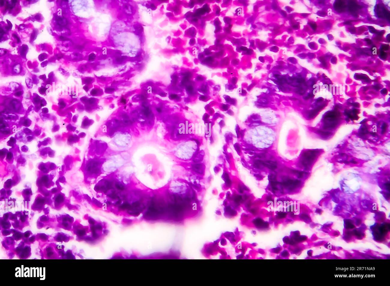 Villous colon adenocarcinoma, light micrograph, photo under microscope ...
