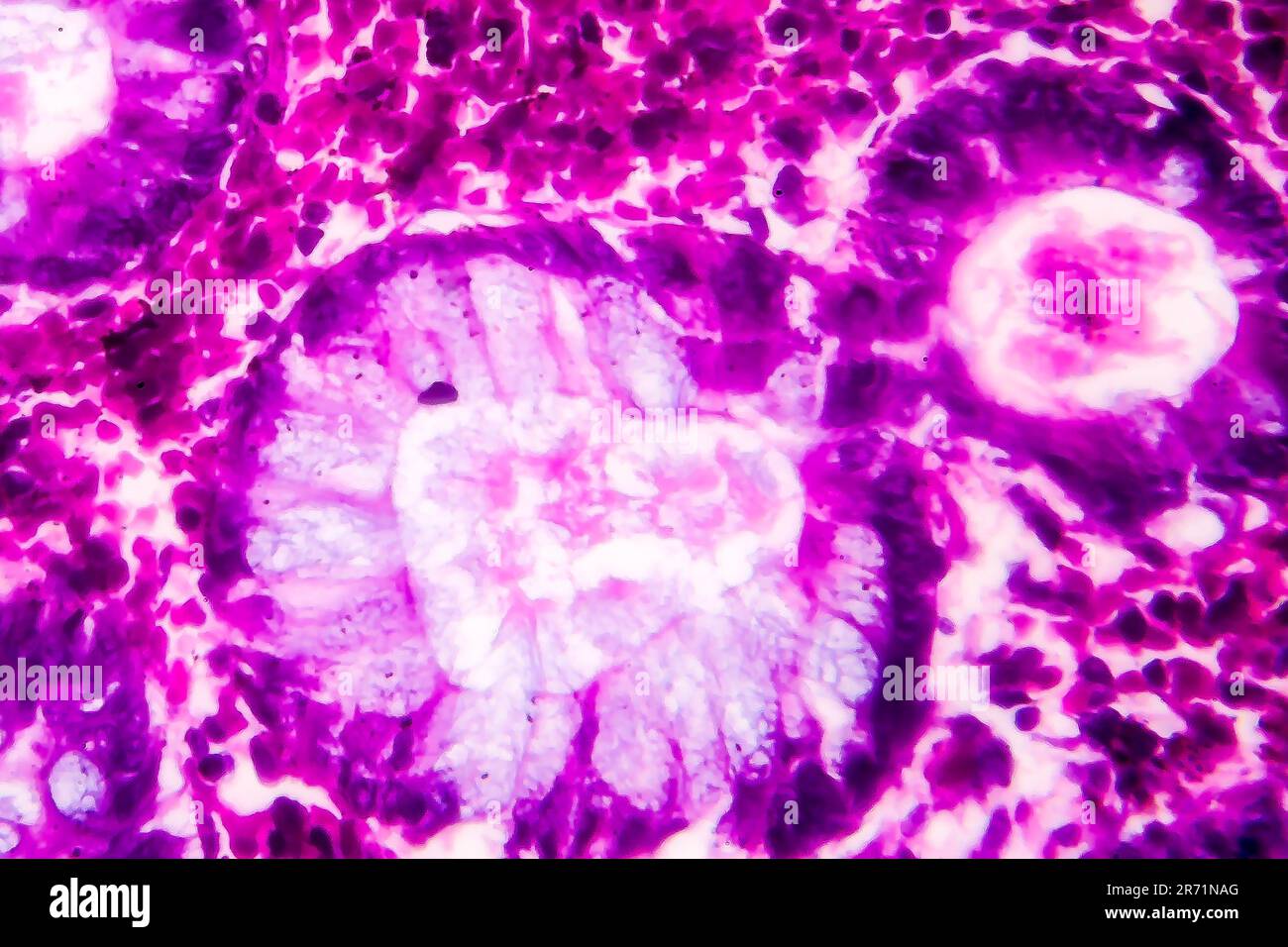 Villous colon adenocarcinoma, light micrograph, photo under microscope ...