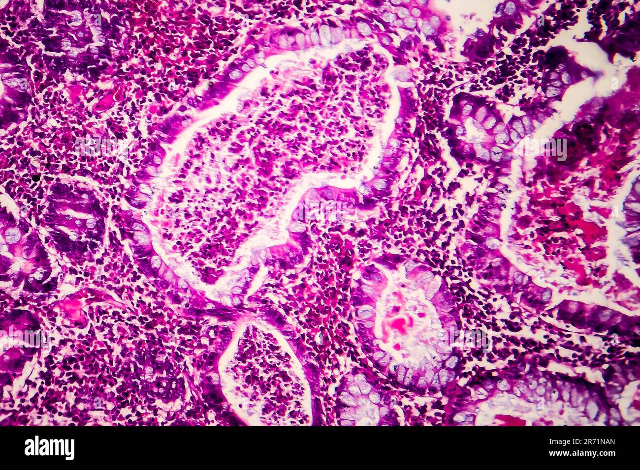 Villous colon adenocarcinoma, light micrograph, photo under microscope ...