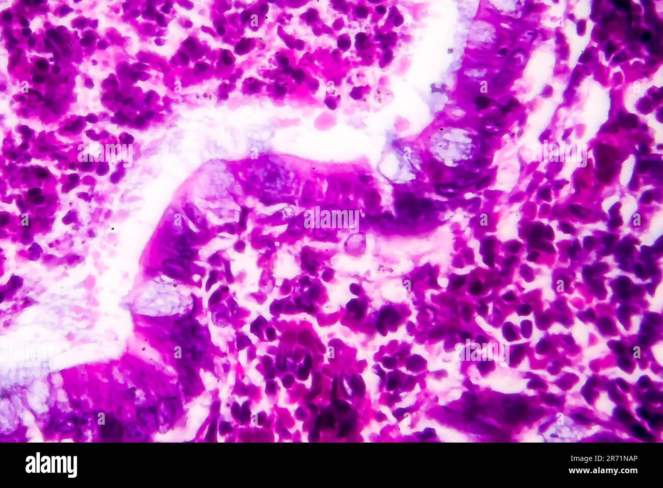Villous colon adenocarcinoma, light micrograph, photo under microscope ...