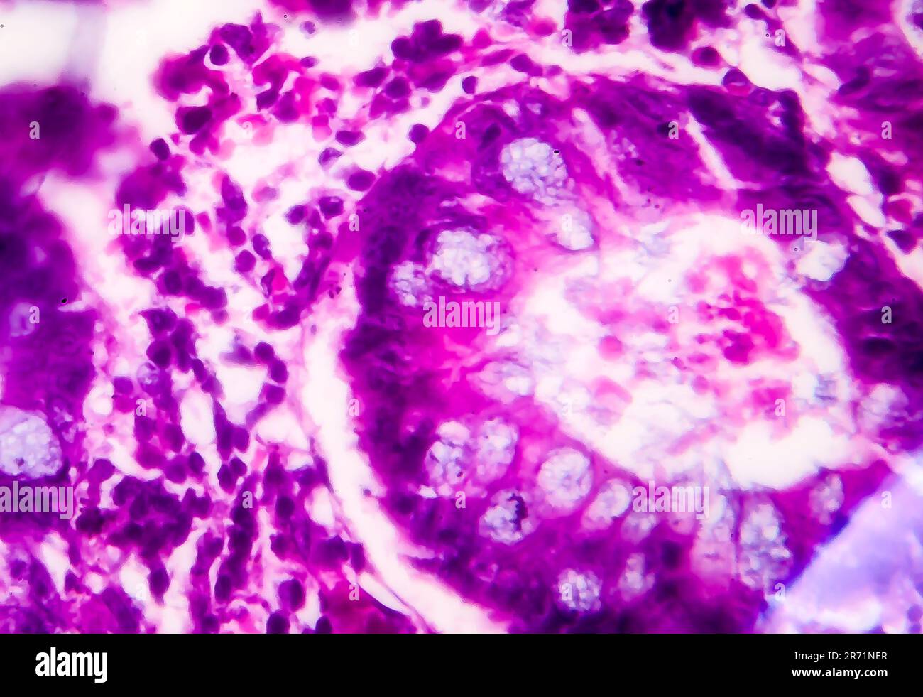 Villous colon adenocarcinoma, light micrograph, photo under microscope ...