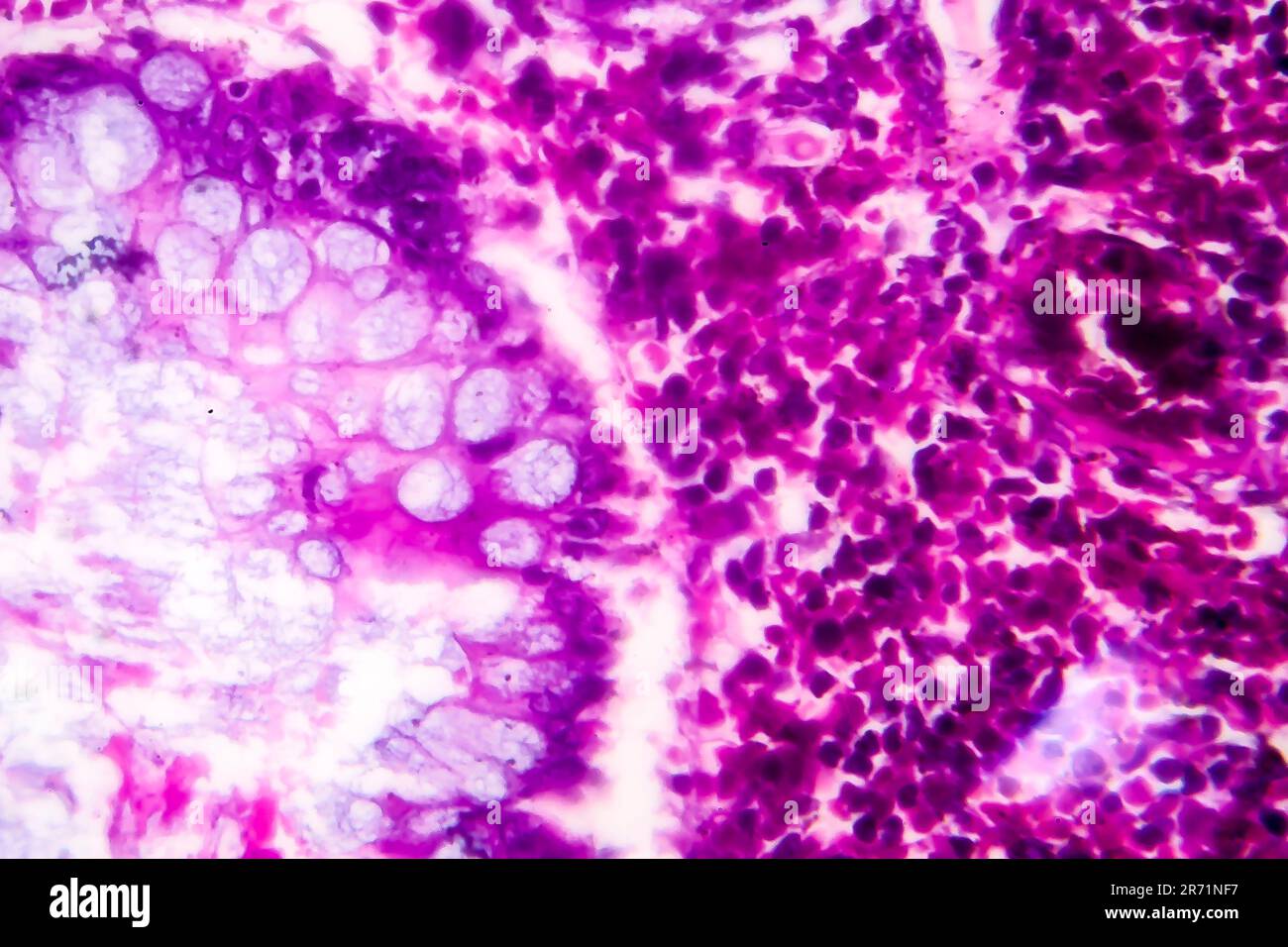 Villous colon adenocarcinoma, light micrograph, photo under microscope ...