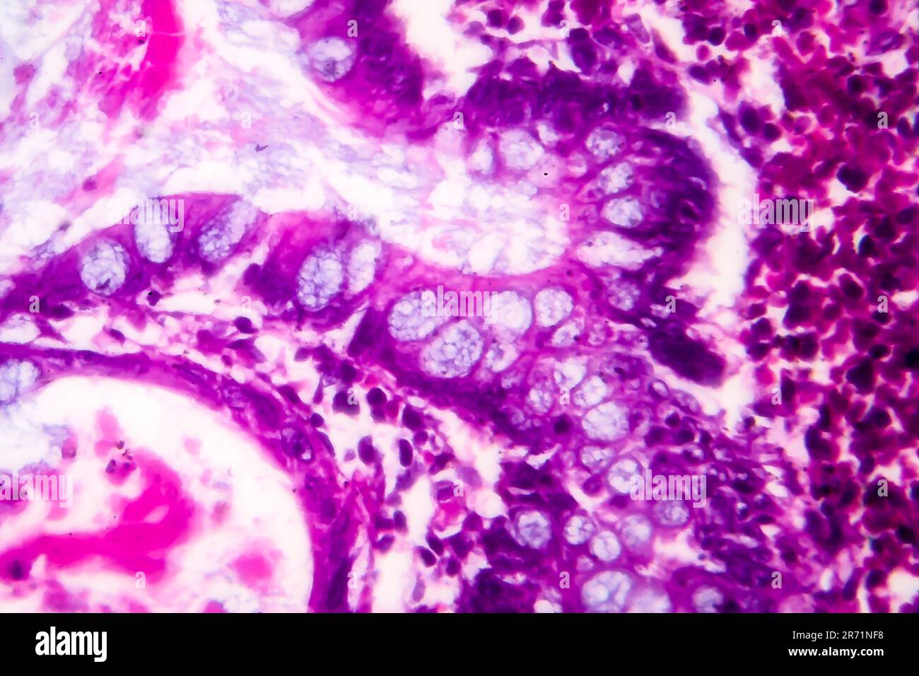Villous colon adenocarcinoma, light micrograph, photo under microscope ...