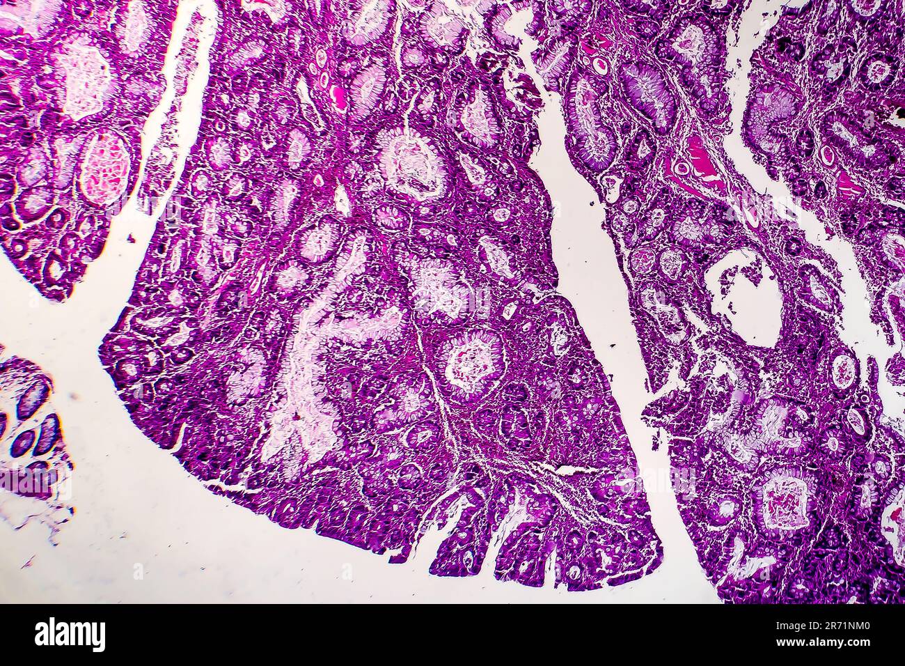 Villous colon adenocarcinoma, light micrograph, photo under microscope ...
