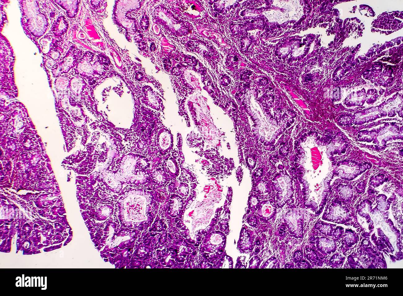 Villous colon adenocarcinoma, light micrograph, photo under microscope ...