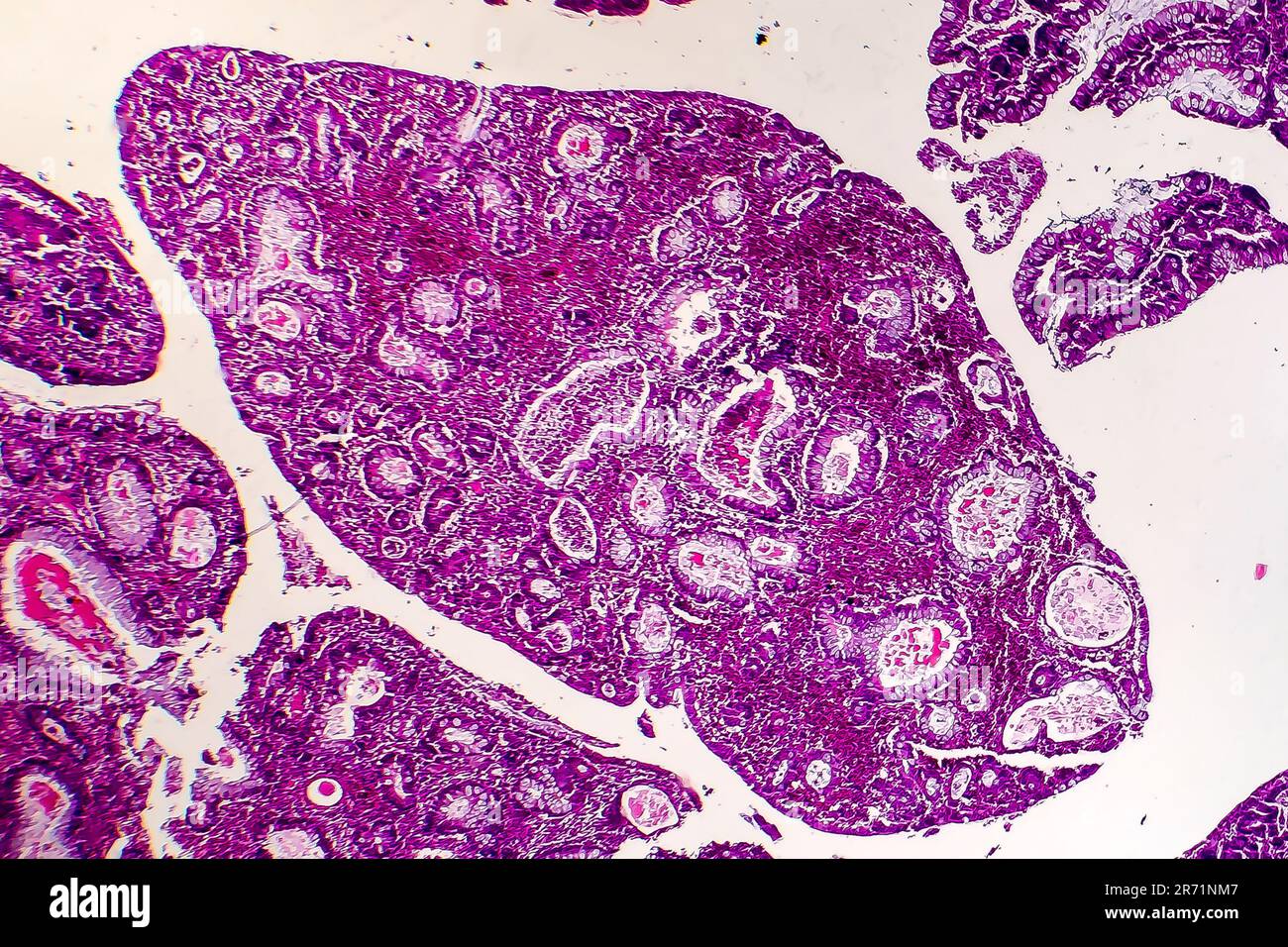 Villous colon adenocarcinoma, light micrograph, photo under microscope ...