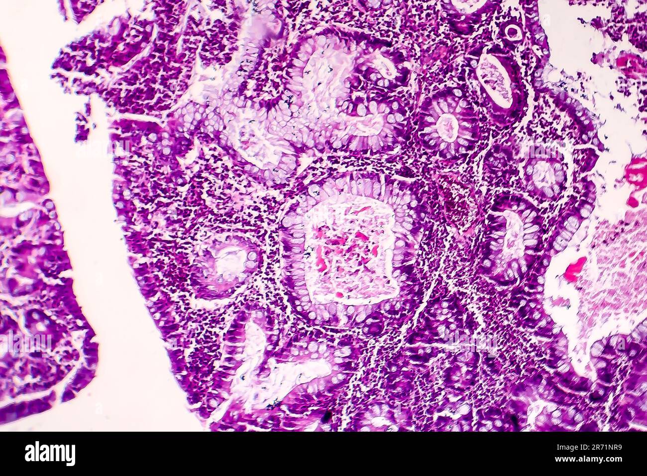 Villous colon adenocarcinoma, light micrograph, photo under microscope ...