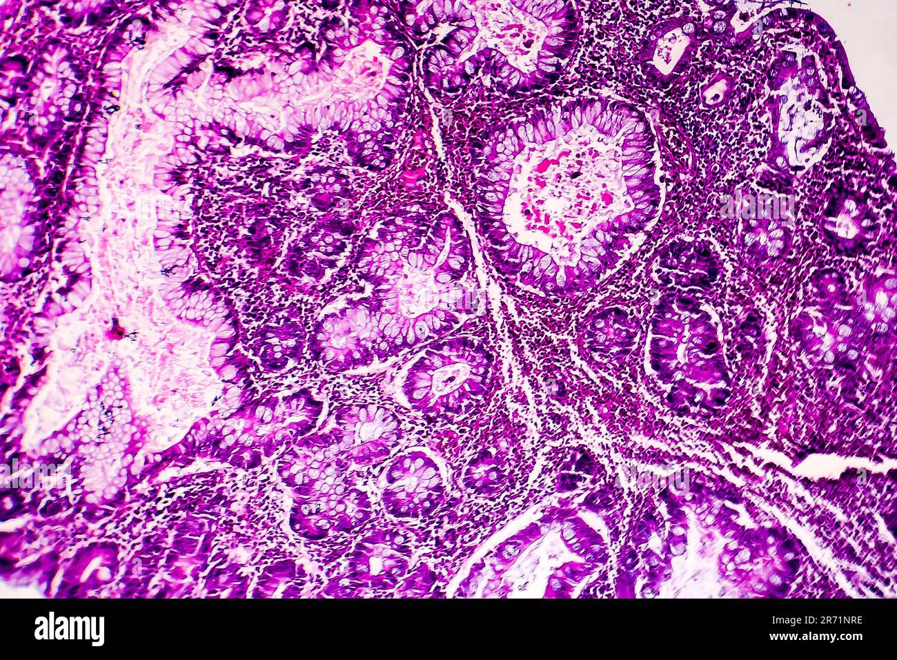 Villous colon adenocarcinoma, light micrograph, photo under microscope ...