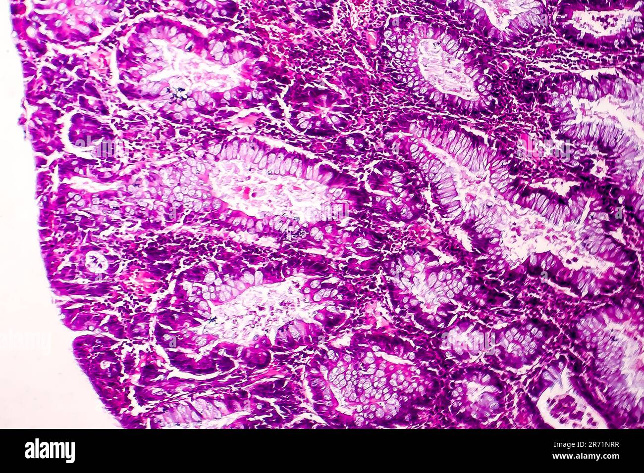 Villous colon adenocarcinoma, light micrograph, photo under microscope ...