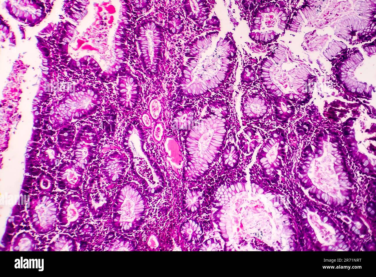 Villous colon adenocarcinoma, light micrograph, photo under microscope ...