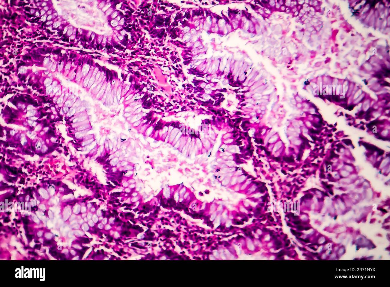 Villous colon adenocarcinoma, light micrograph, photo under microscope ...
