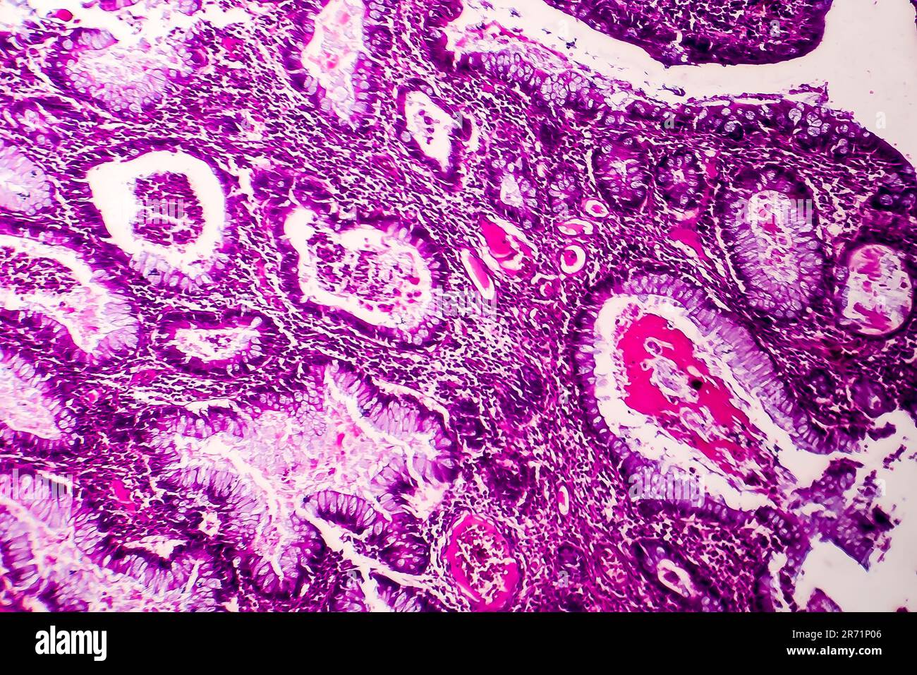Villous colon adenocarcinoma, light micrograph, photo under microscope ...