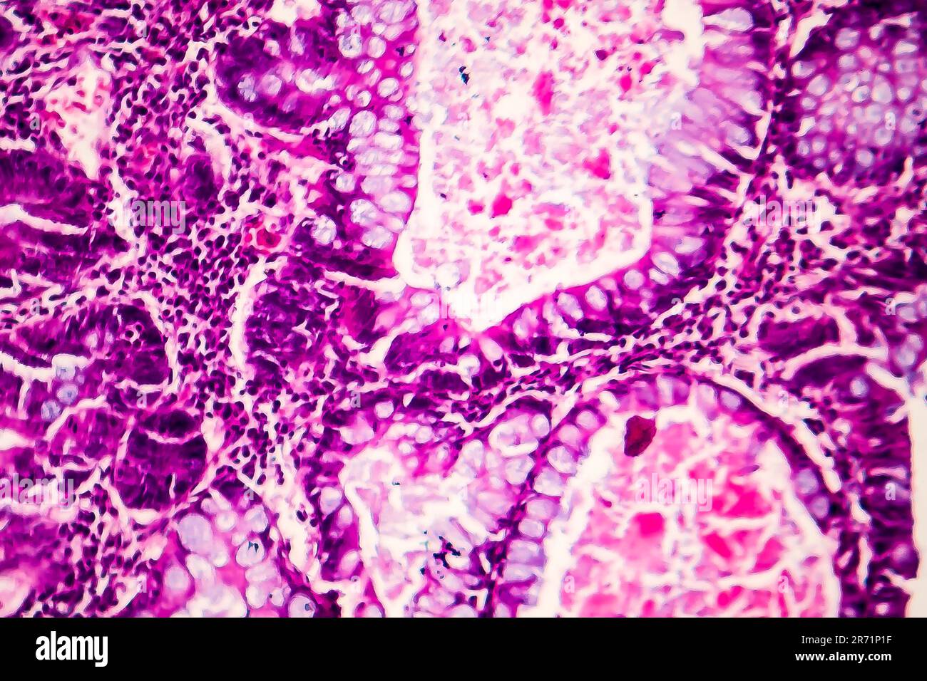 Villous colon adenocarcinoma, light micrograph, photo under microscope ...