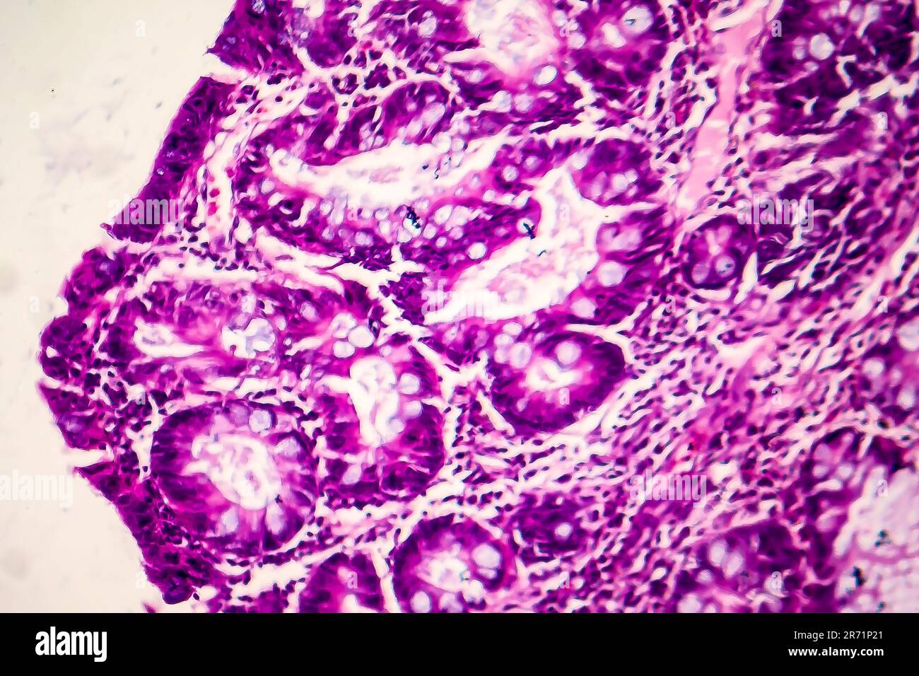 Villous colon adenocarcinoma, light micrograph, photo under microscope ...