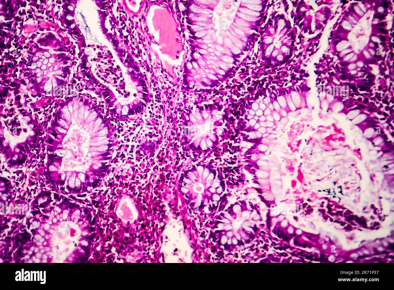 Villous colon adenocarcinoma, light micrograph, photo under microscope ...