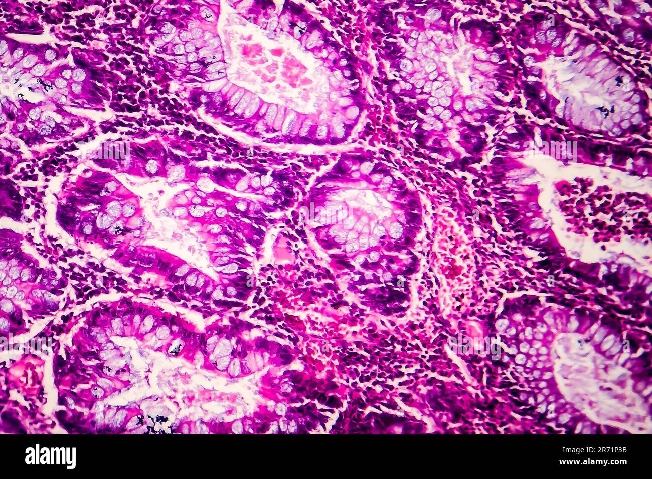 Villous colon adenocarcinoma, light micrograph, photo under microscope ...
