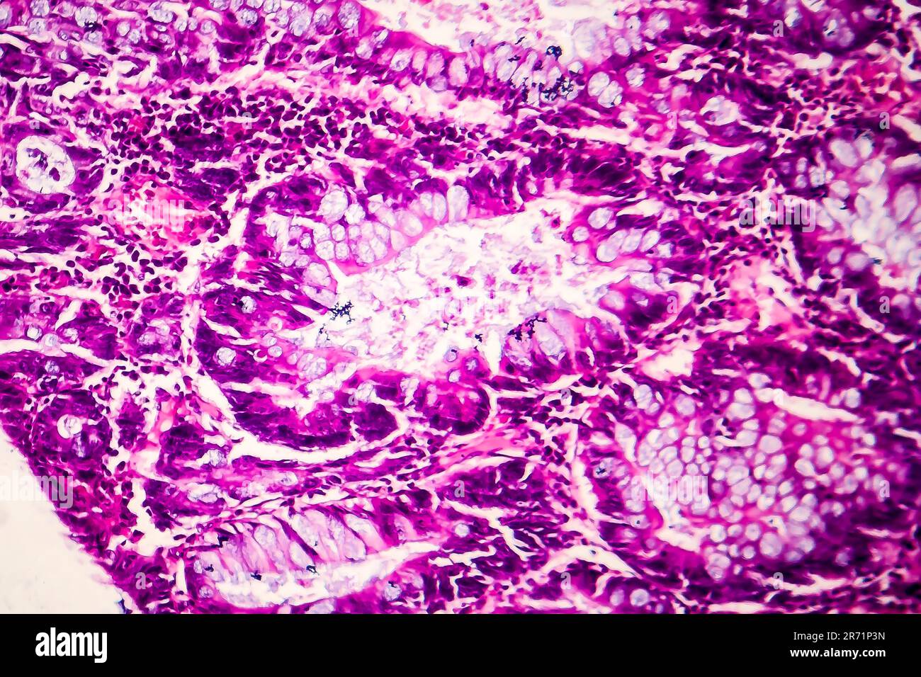 Villous colon adenocarcinoma, light micrograph, photo under microscope ...