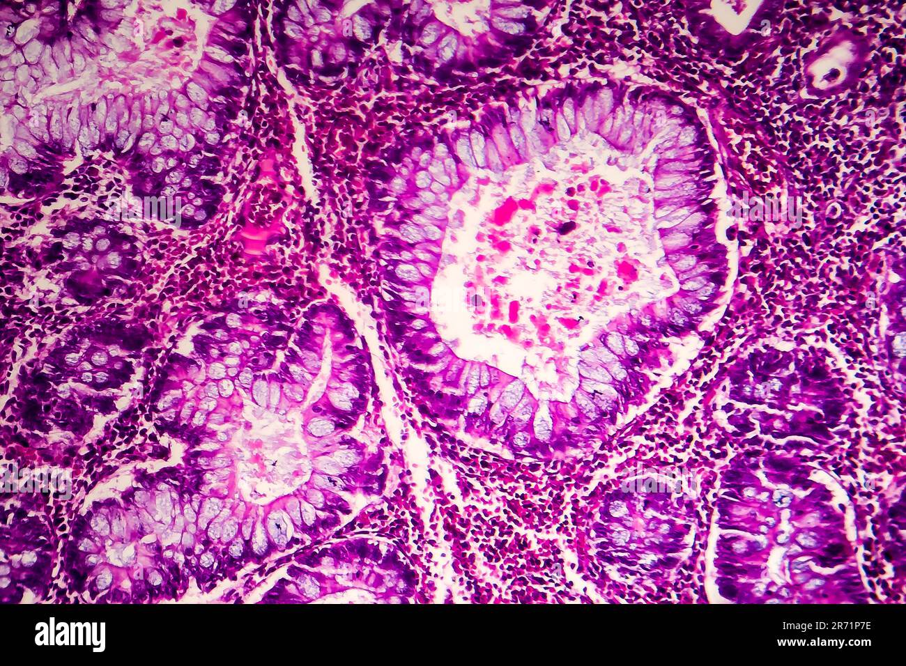 Villous colon adenocarcinoma, light micrograph, photo under microscope ...