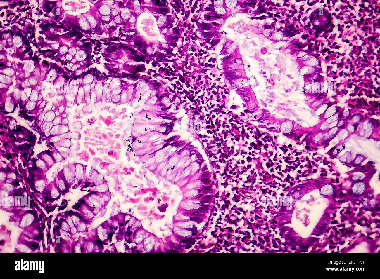 Villous colon adenocarcinoma, light micrograph, photo under microscope ...