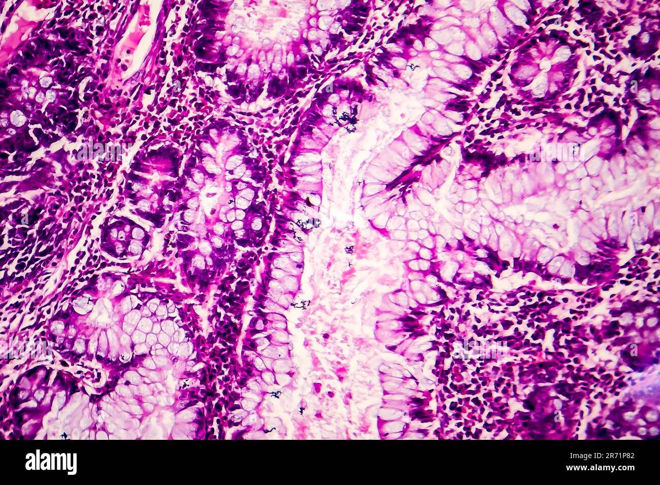 Villous colon adenocarcinoma, light micrograph, photo under microscope ...