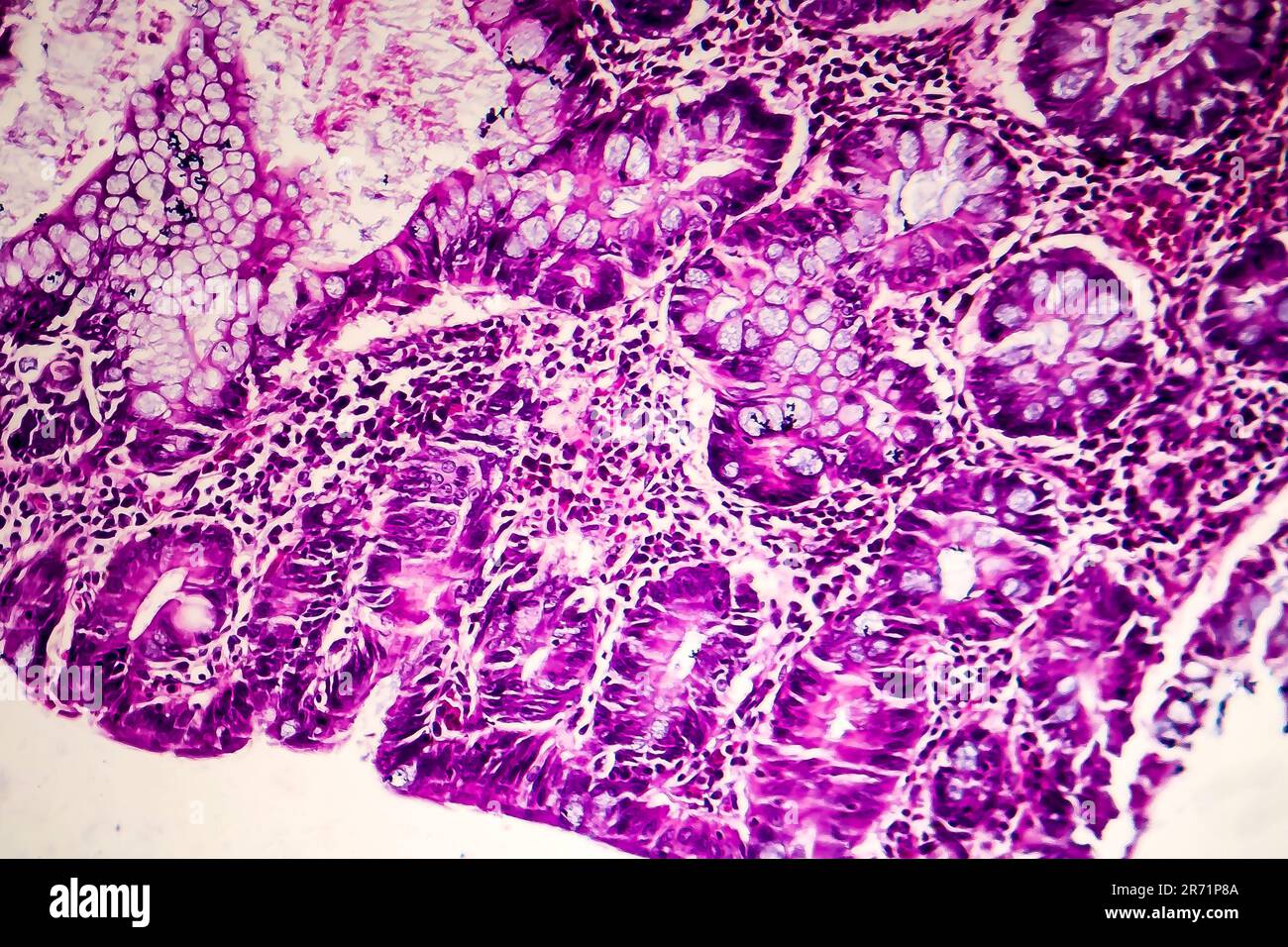 Villous colon adenocarcinoma, light micrograph, photo under microscope ...