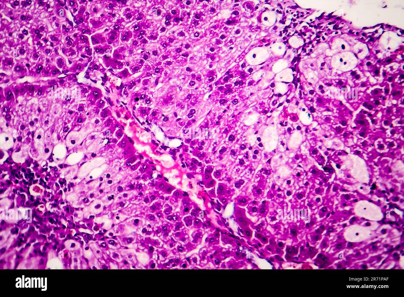 Histopathology of acute hepatitis, light micrograph, photo under ...