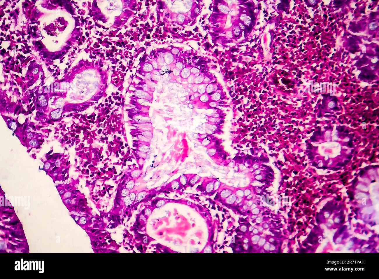 Villous colon adenocarcinoma, light micrograph, photo under microscope ...