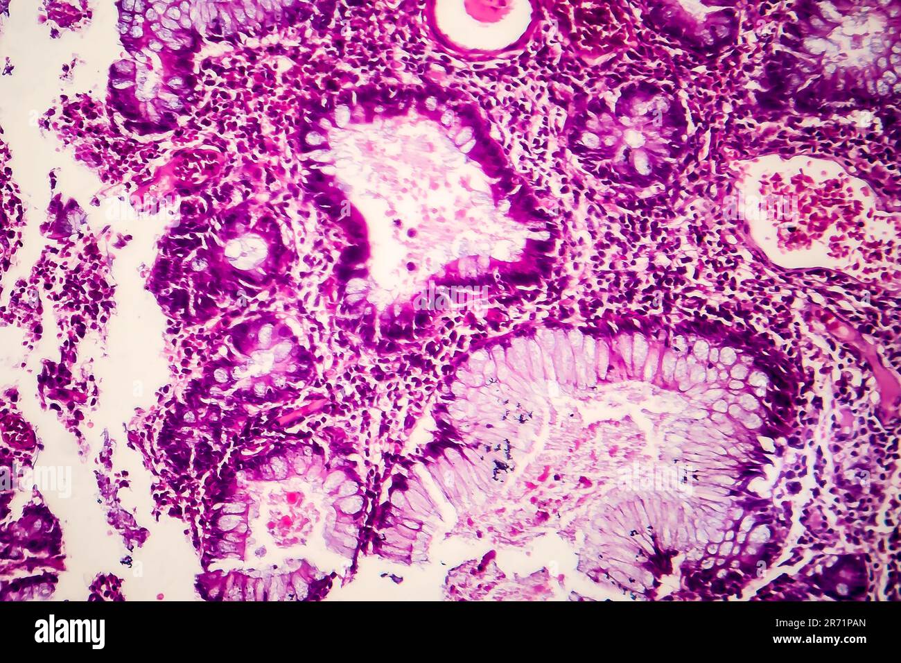 Villous colon adenocarcinoma, light micrograph, photo under microscope ...