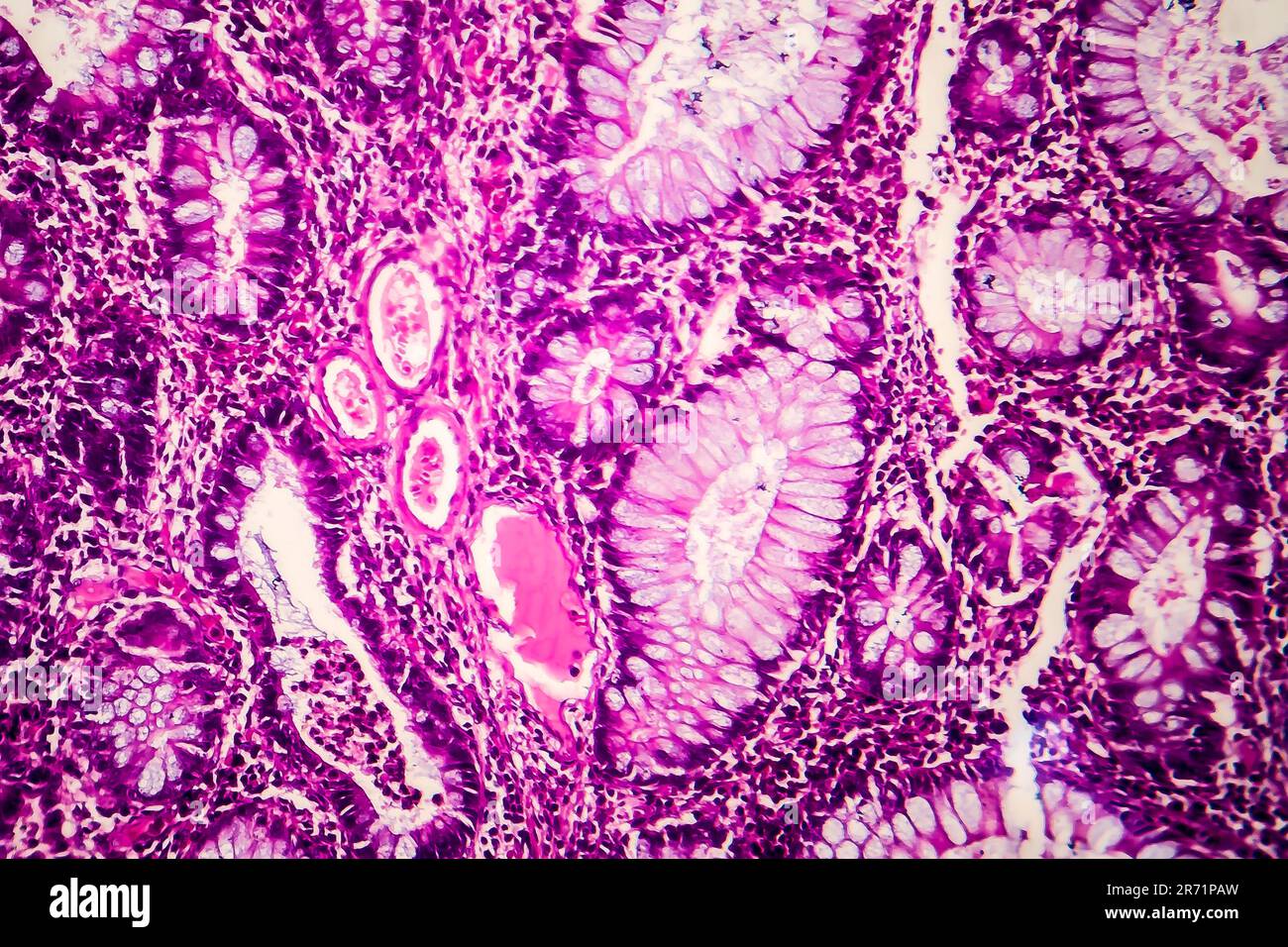 Villous colon adenocarcinoma, light micrograph, photo under microscope ...
