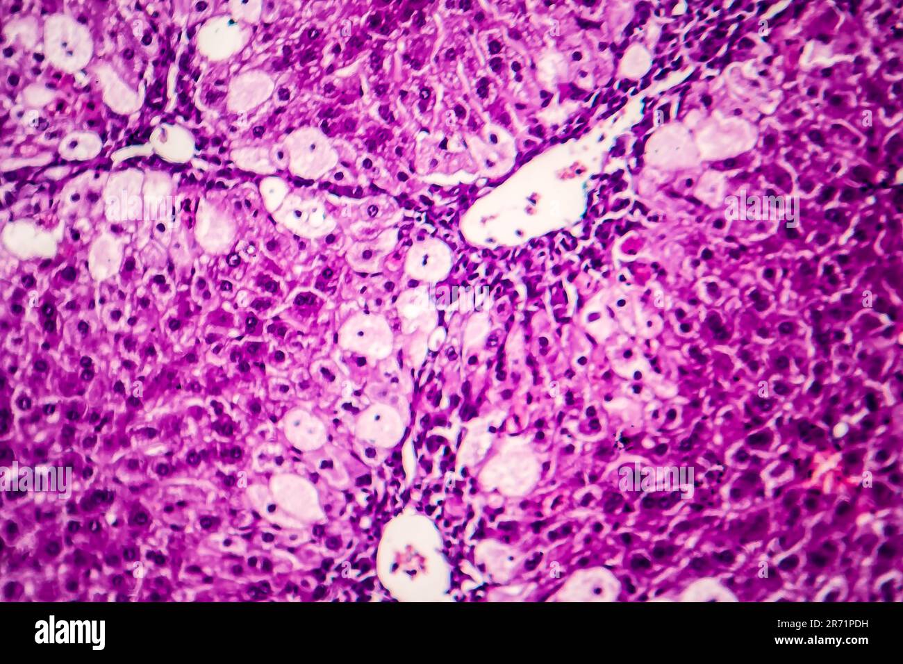 Histopathology of acute hepatitis, light micrograph, photo under ...