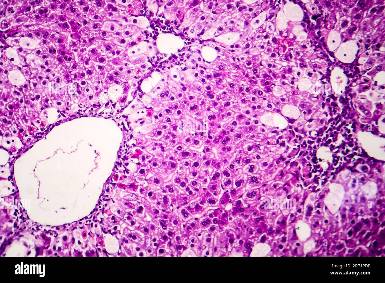 Histopathology of acute hepatitis, light micrograph, photo under ...