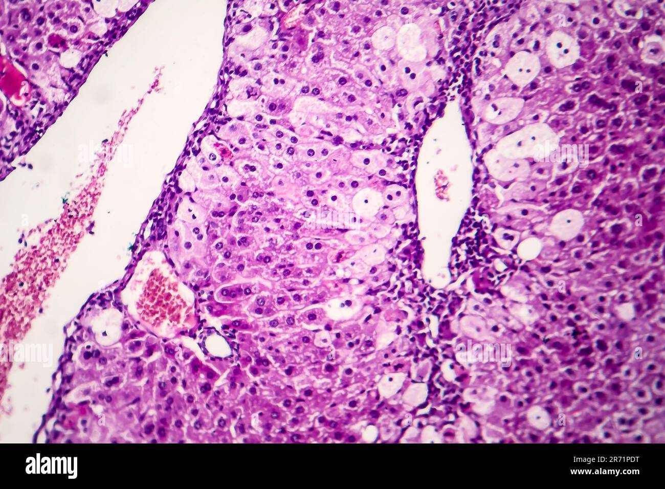 Histopathology of acute hepatitis, light micrograph, photo under ...