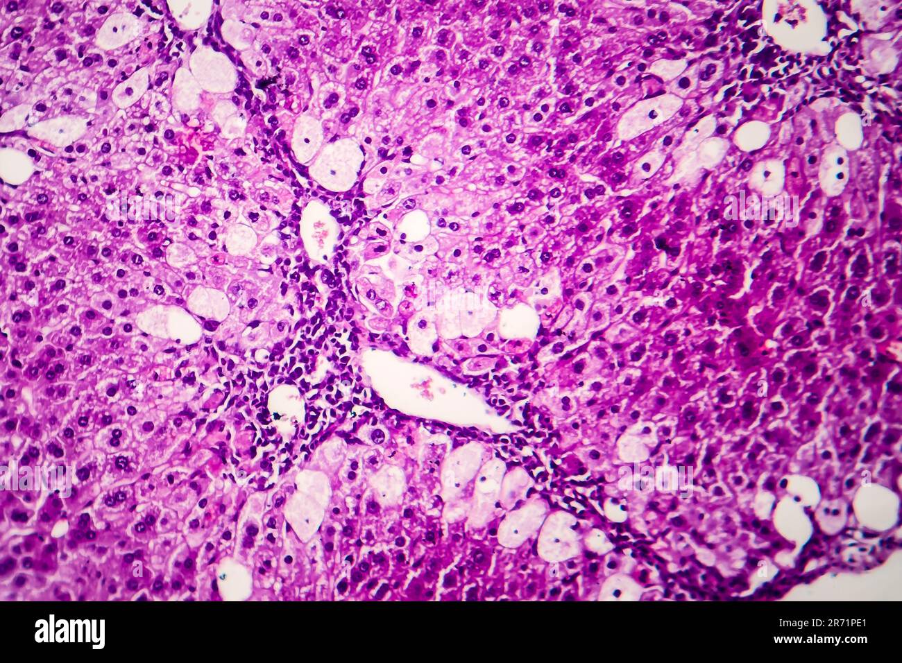 Histopathology of acute hepatitis, light micrograph, photo under ...