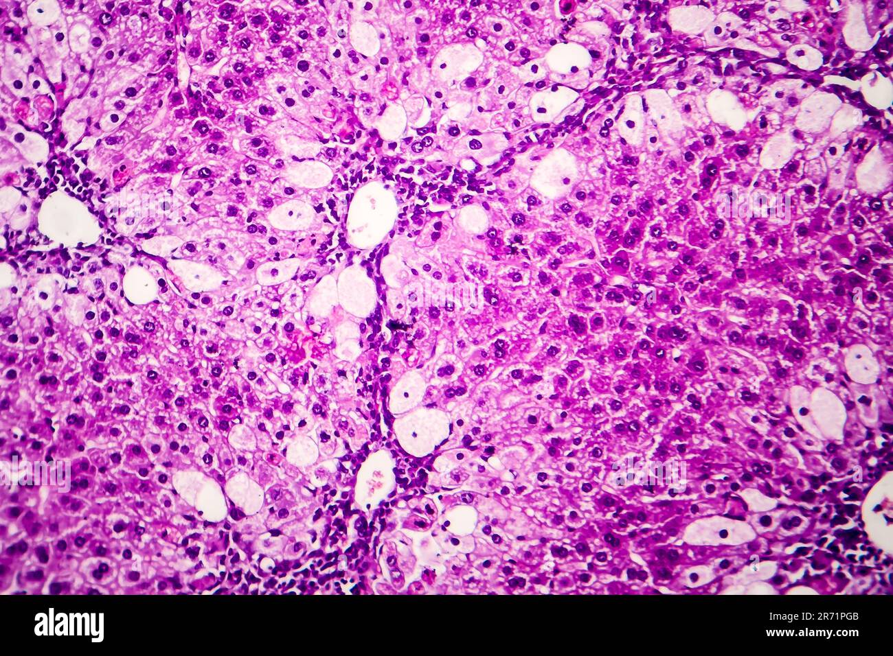 Histopathology of acute hepatitis, light micrograph, photo under ...