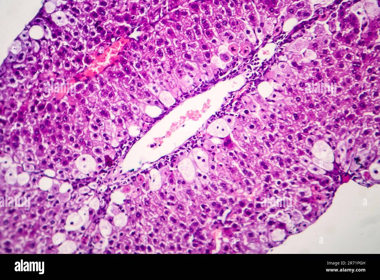 Histopathology of acute hepatitis, light micrograph, photo under ...