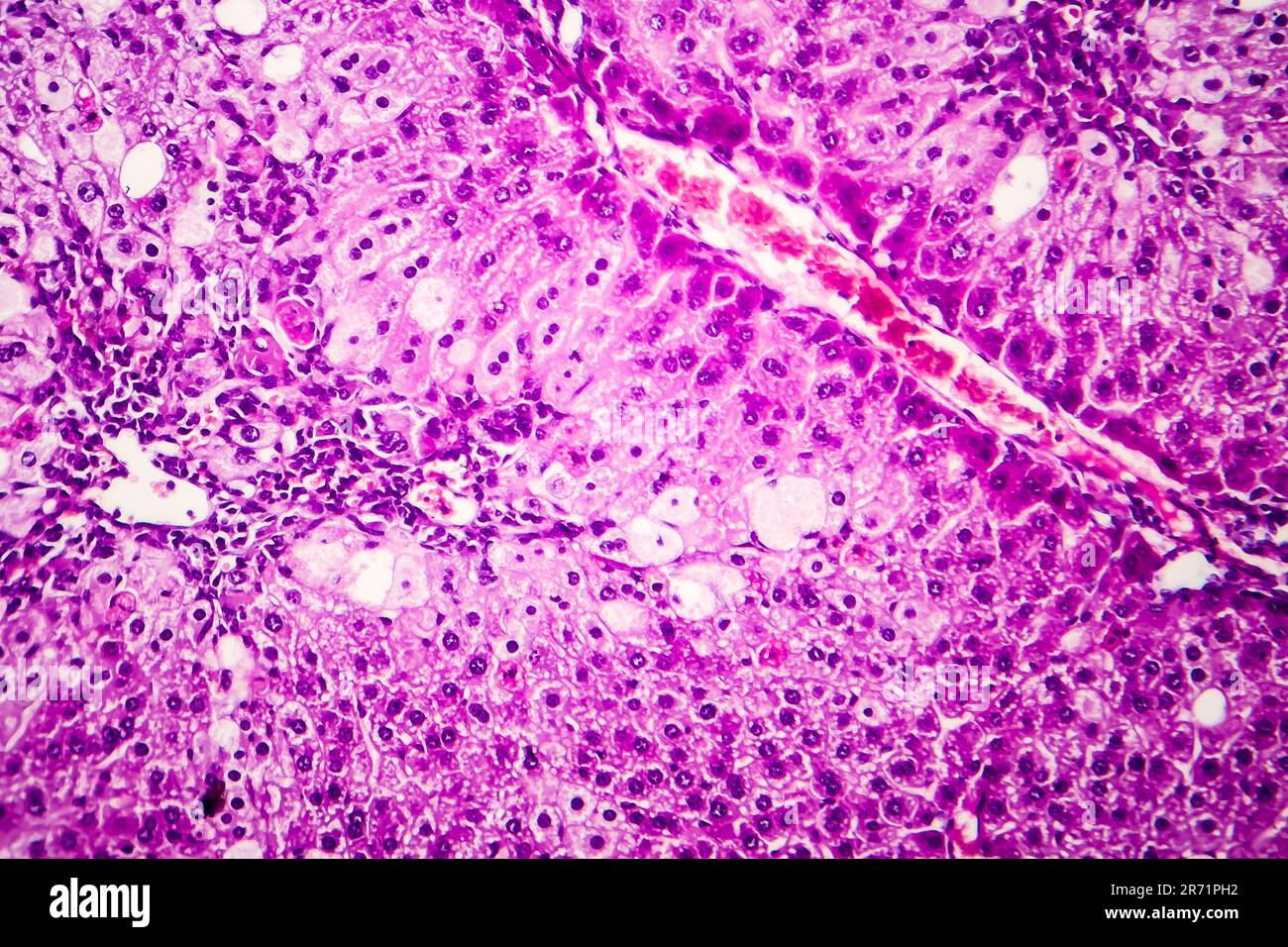 Histopathology of acute hepatitis, light micrograph, photo under ...