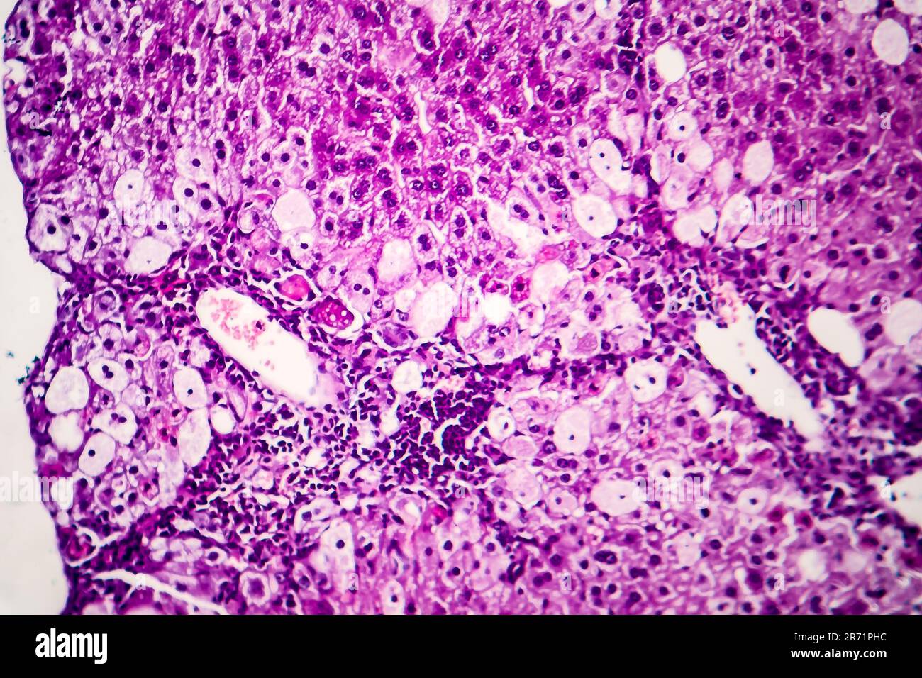 Histopathology of acute hepatitis, light micrograph, photo under ...