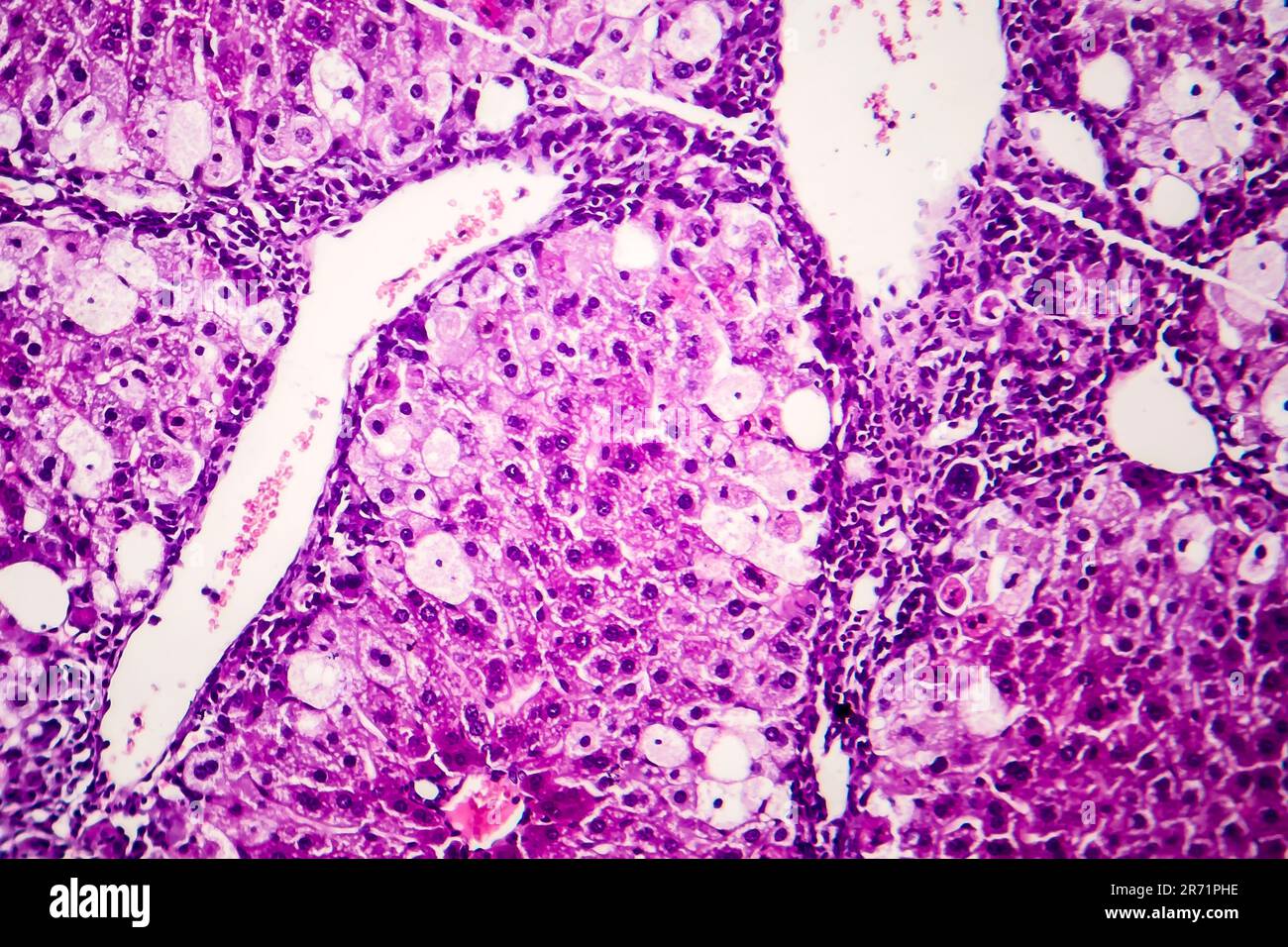 Histopathology of acute hepatitis, light micrograph, photo under ...