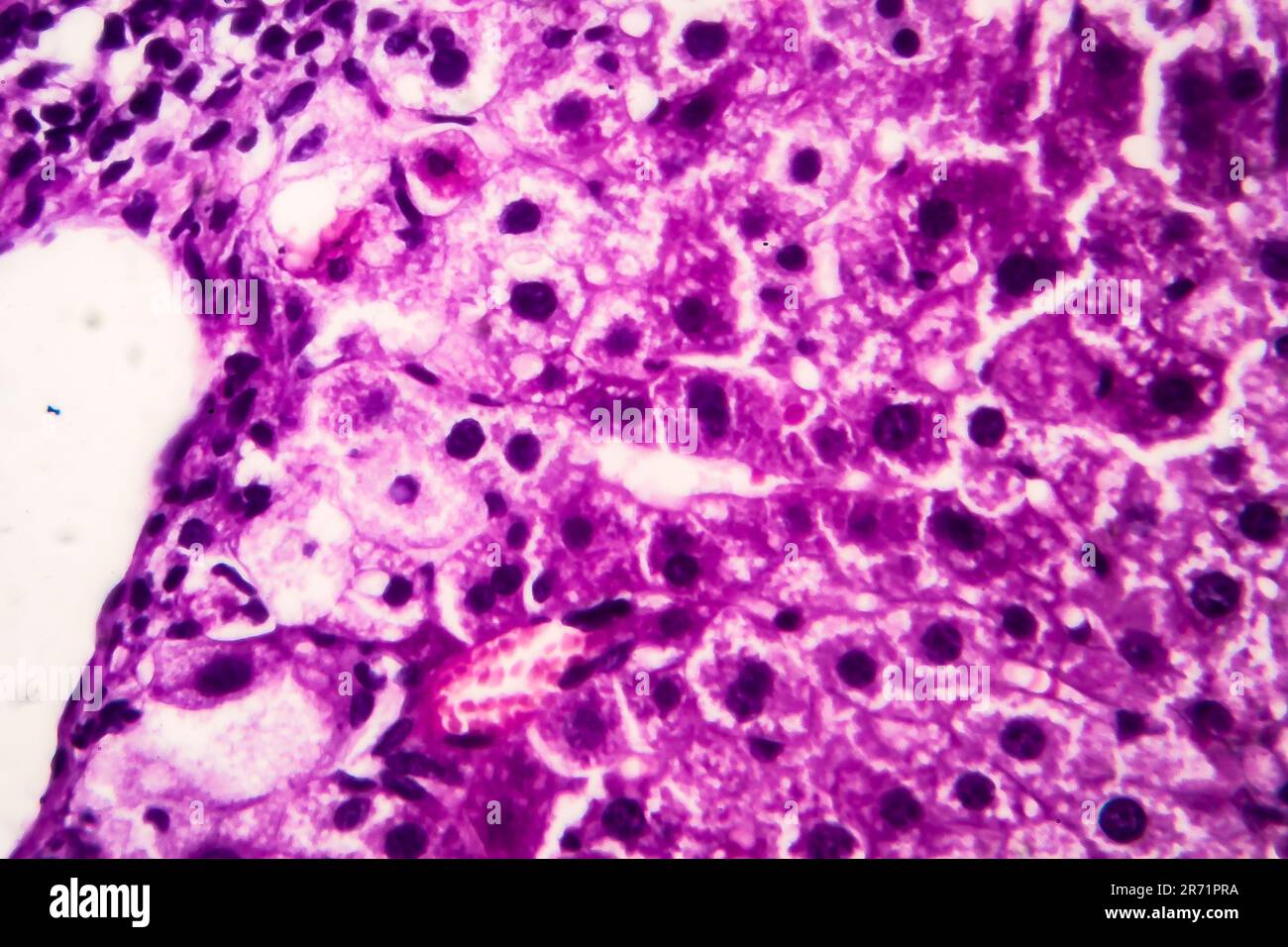 Histopathology of acute hepatitis, light micrograph, photo under ...