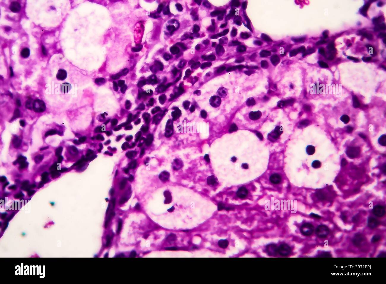 Histopathology of acute hepatitis, light micrograph, photo under ...