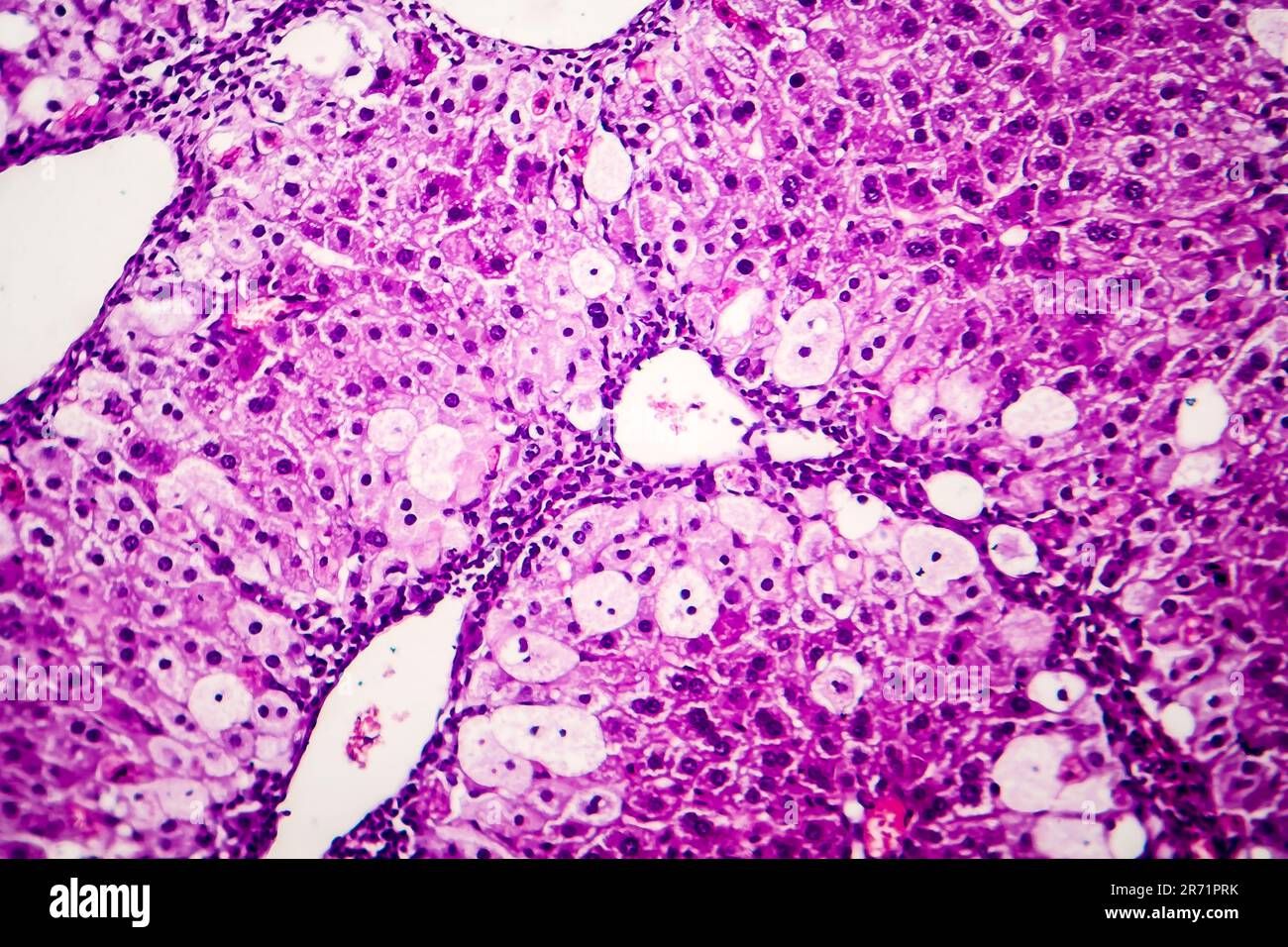 Histopathology of acute hepatitis, light micrograph, photo under ...