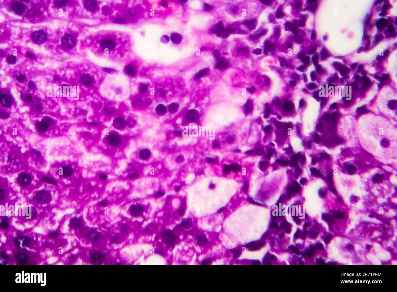Histopathology of acute hepatitis, light micrograph, photo under ...