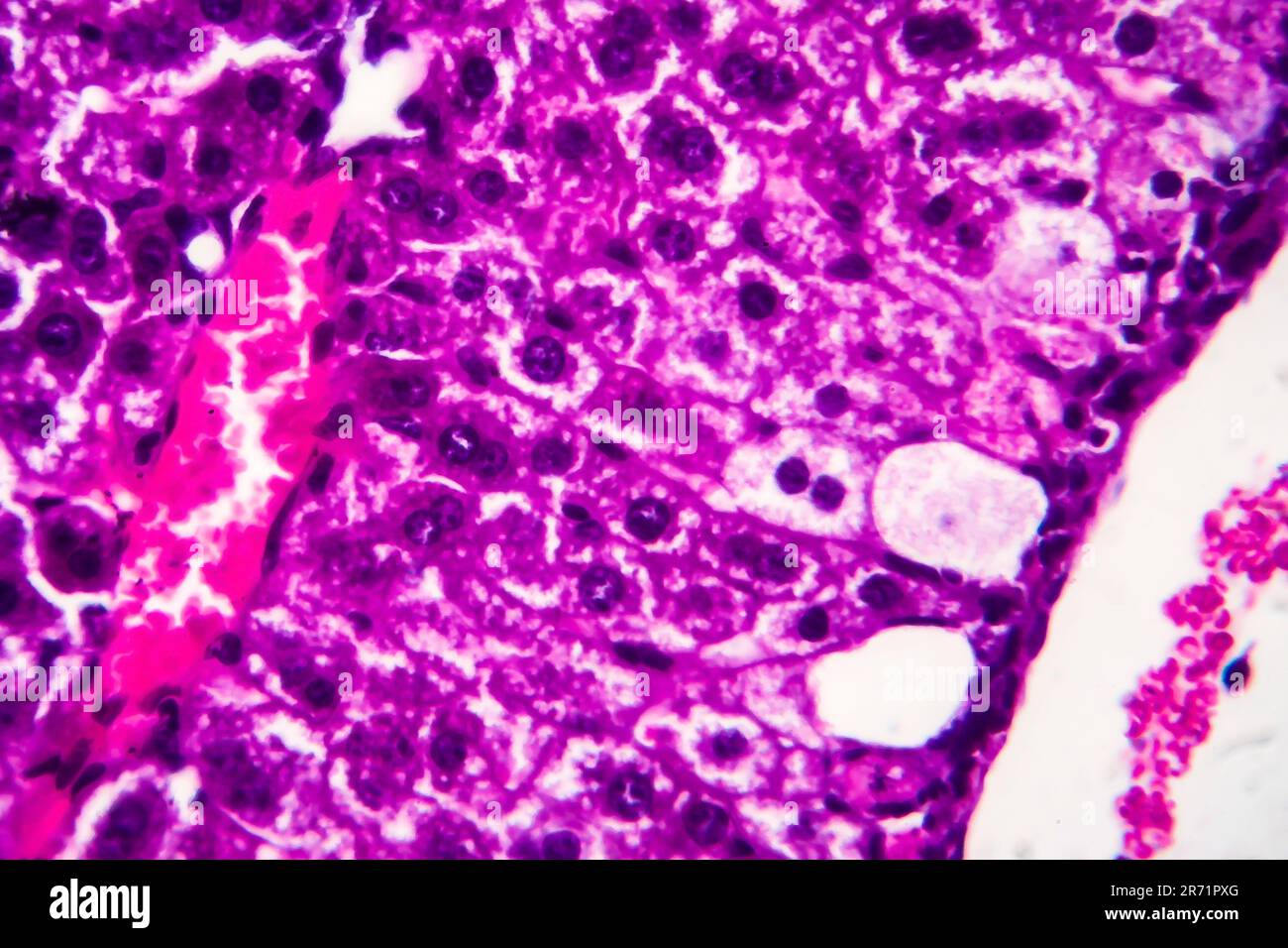 Histopathology of acute hepatitis, light micrograph, photo under ...
