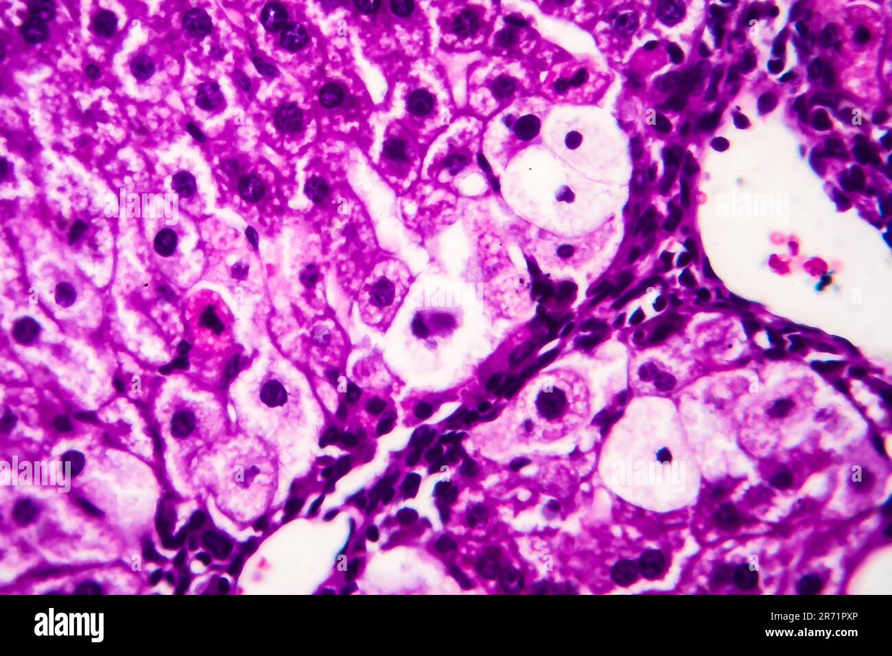 Histopathology of acute hepatitis, light micrograph, photo under ...
