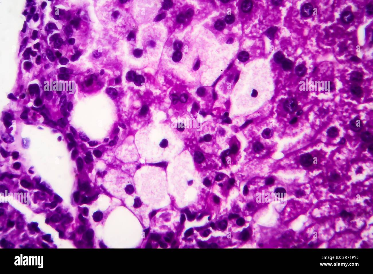 Histopathology of acute hepatitis, light micrograph, photo under ...
